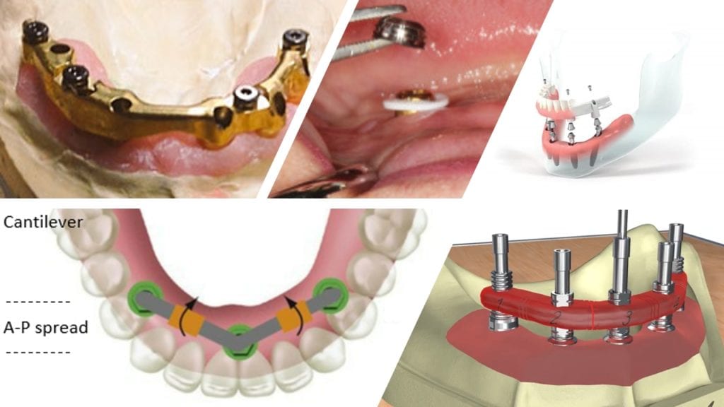 Full Arch Implant Restorations and Surgical Guides – Module #3
