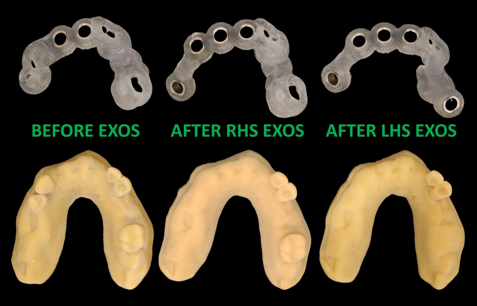 Full Arch Implant Restorations and Surgical Guides – Module #3